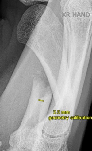 Use of NX Nail for oblique fracture fixation of 2nd metacarpal